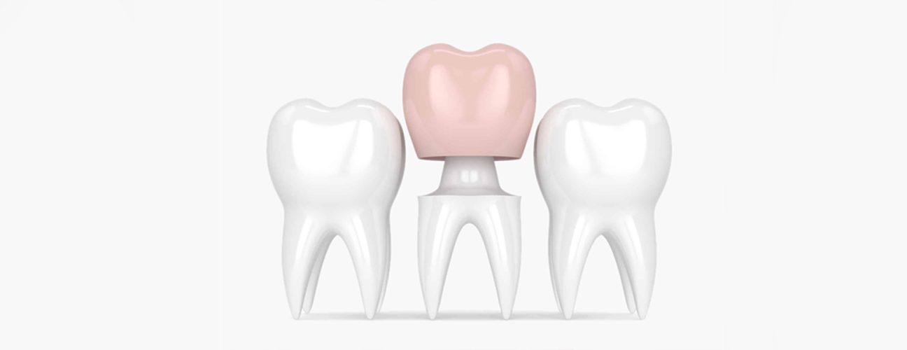 What to Do If Your Dental Crown Breaks: Key Steps and Treatment Options